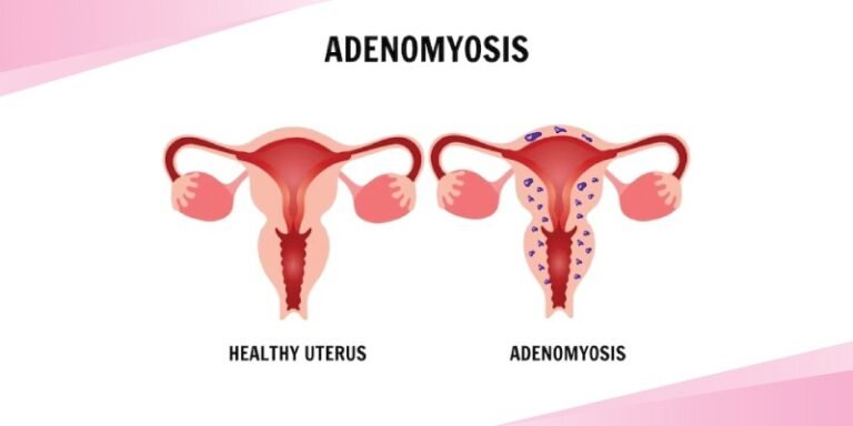 Endometriosis And Adenomyosis тау ёэчыёэч ёэч ёэч ёэчкёэч ёэч ёэч ёэч ёэша ёэчыёэч ёэшаёэч ёэч ёэшбё